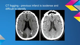 The radiology of an ischaemic stroke | PPTX