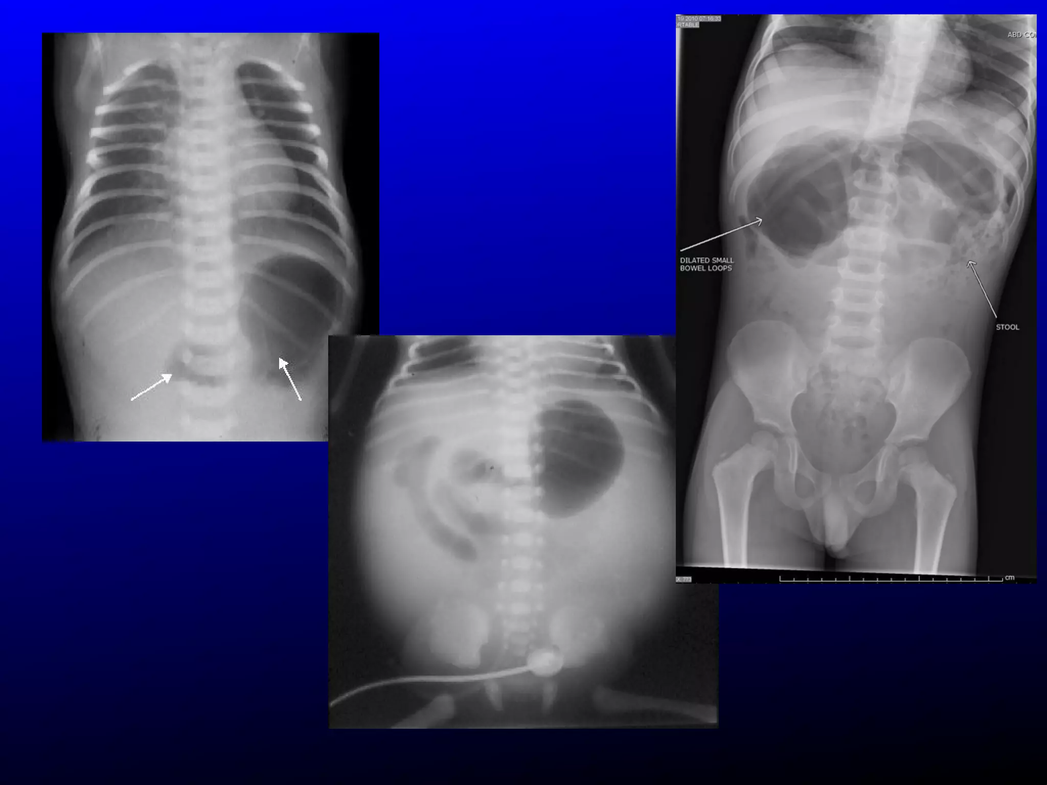 The Radiology of Malrotation | PPT