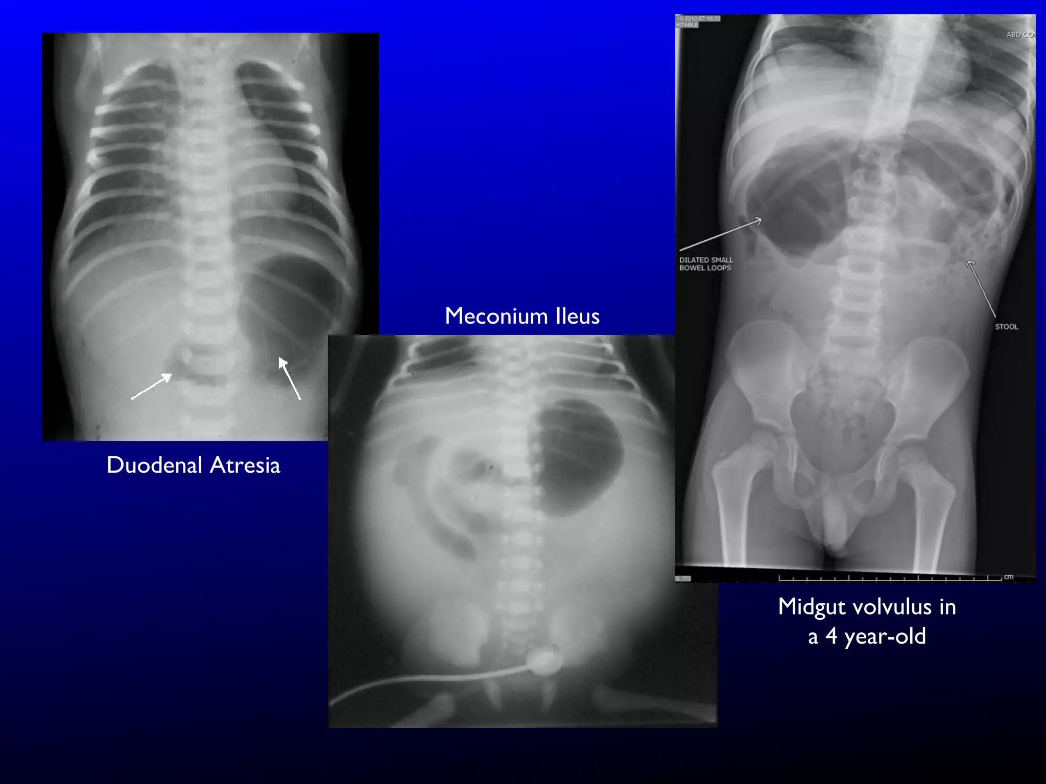 The Radiology of Malrotation | PPT