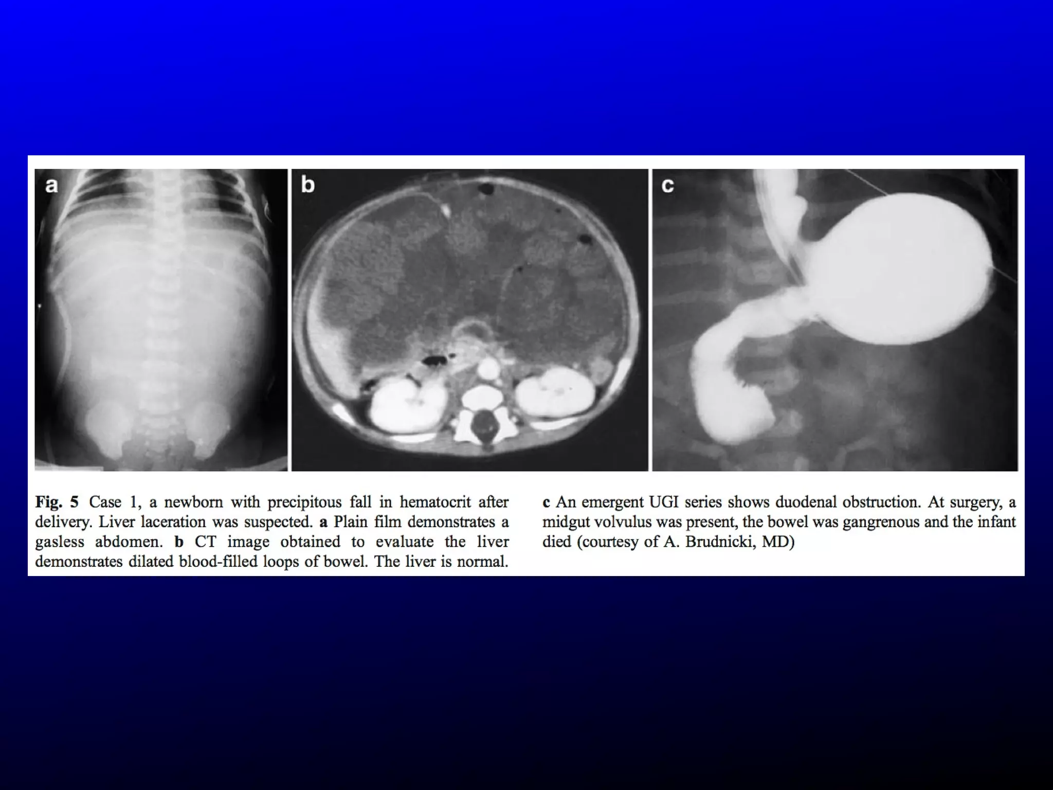 The Radiology of Malrotation | PPT