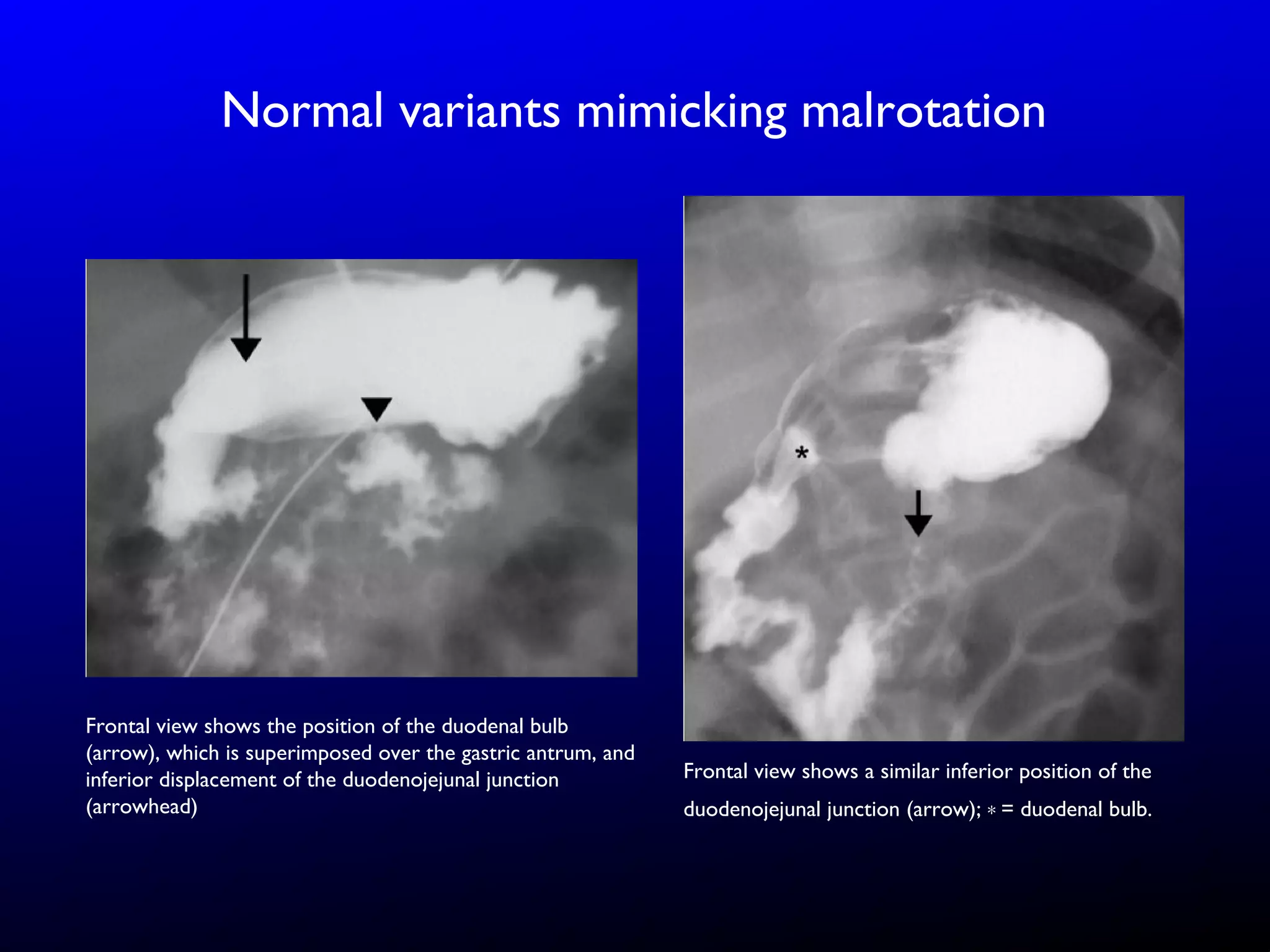 The Radiology of Malrotation | PPT