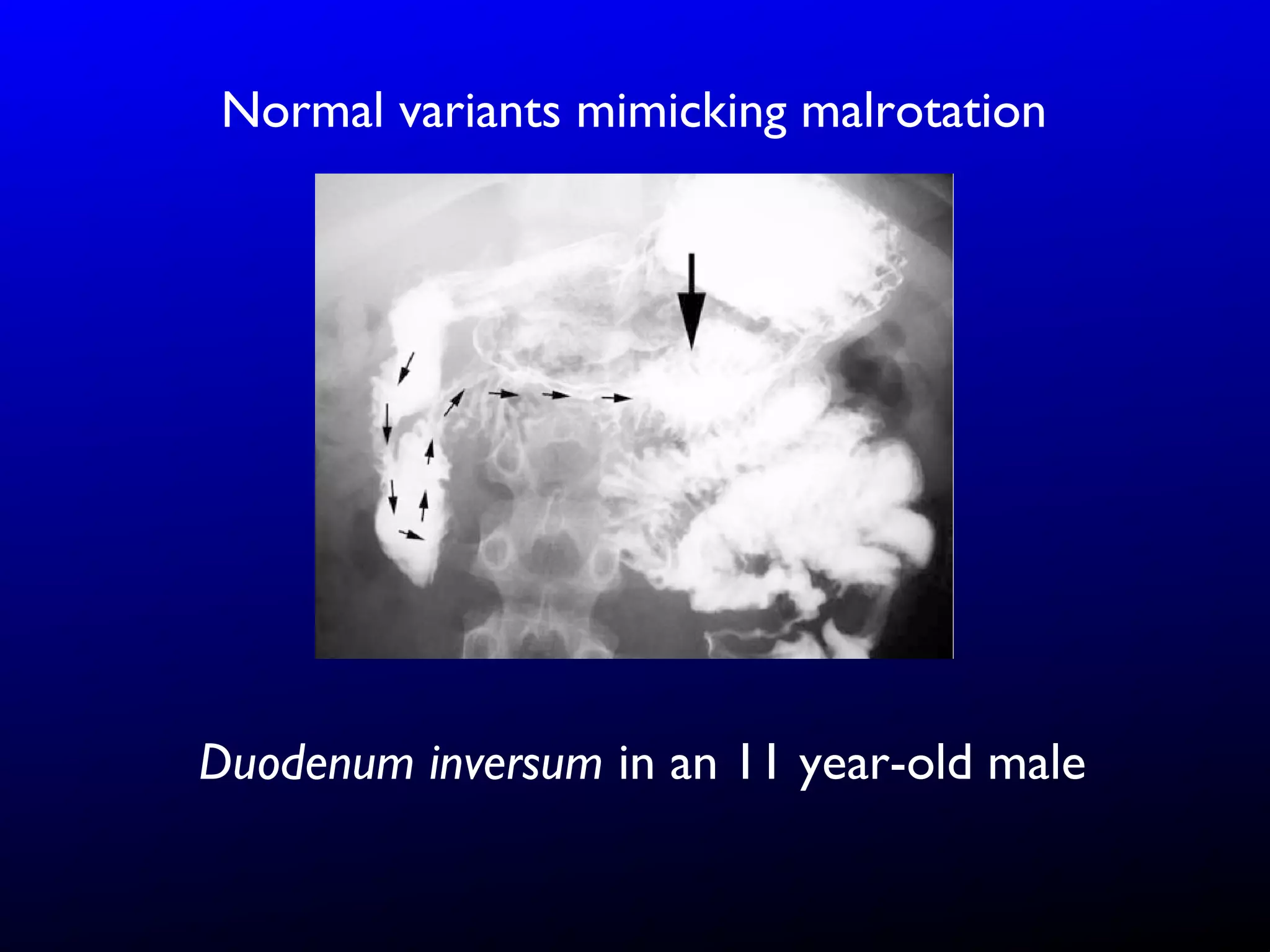 The Radiology of Malrotation | PPT