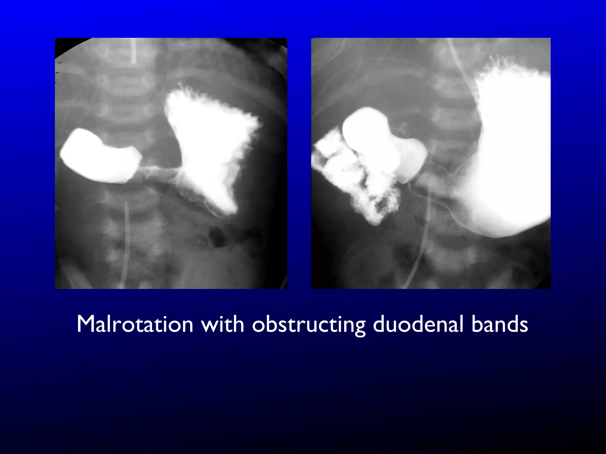 The Radiology of Malrotation | PPT