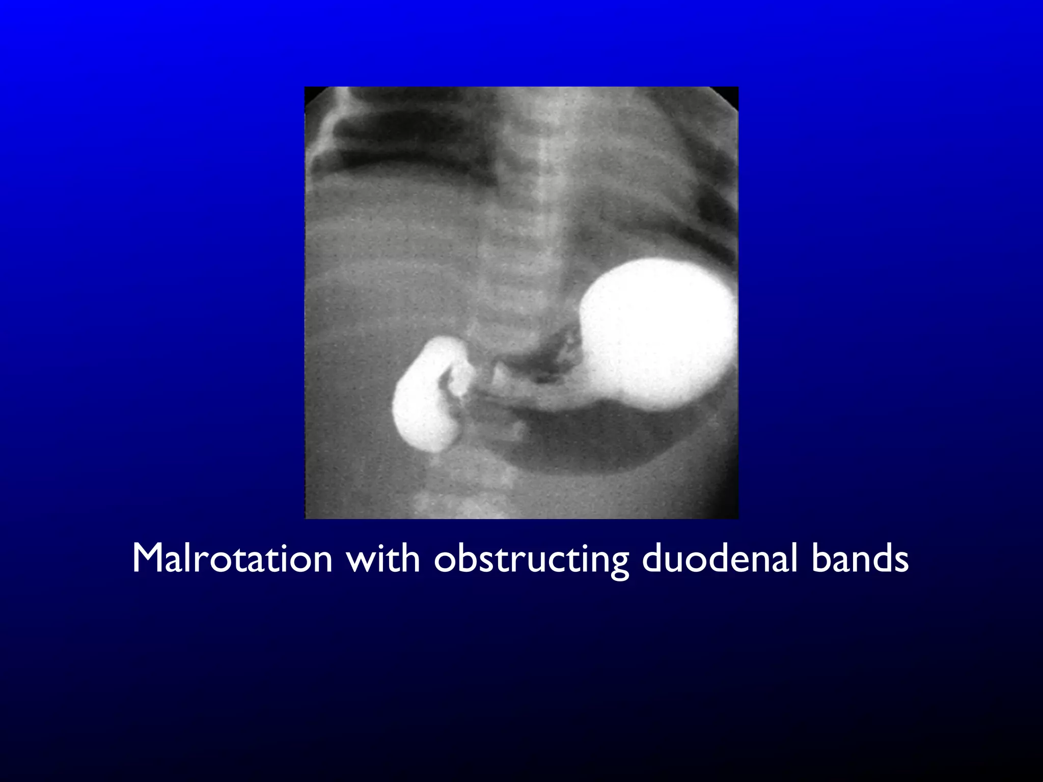 The Radiology of Malrotation | PPT