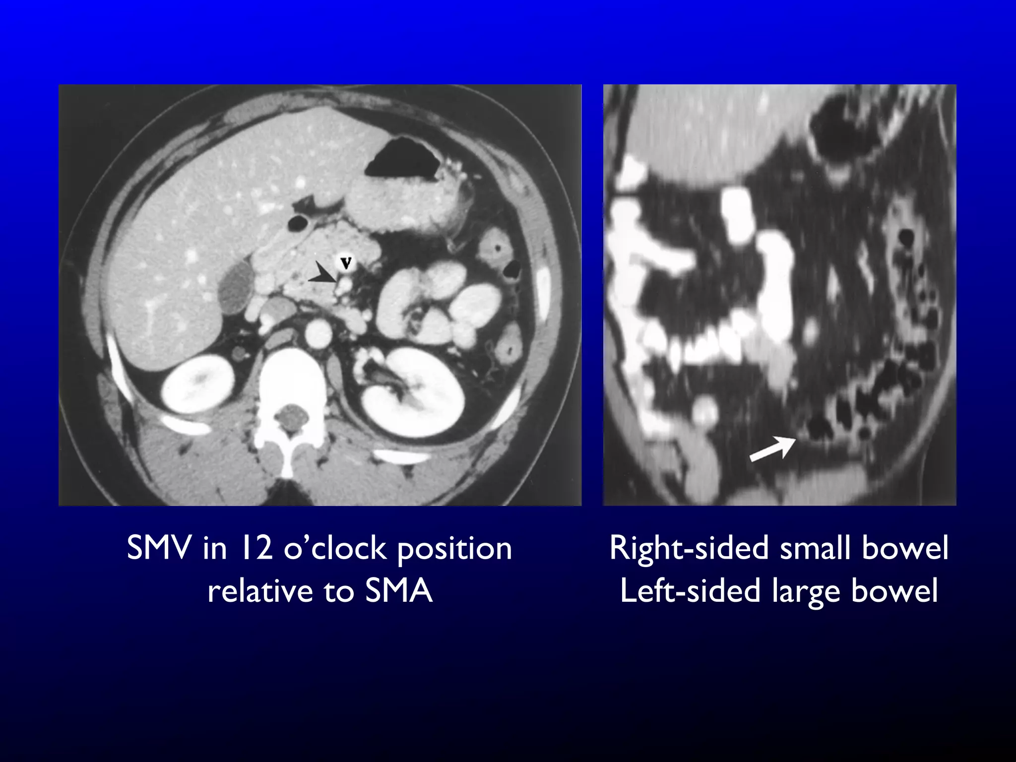 The Radiology of Malrotation | PPT