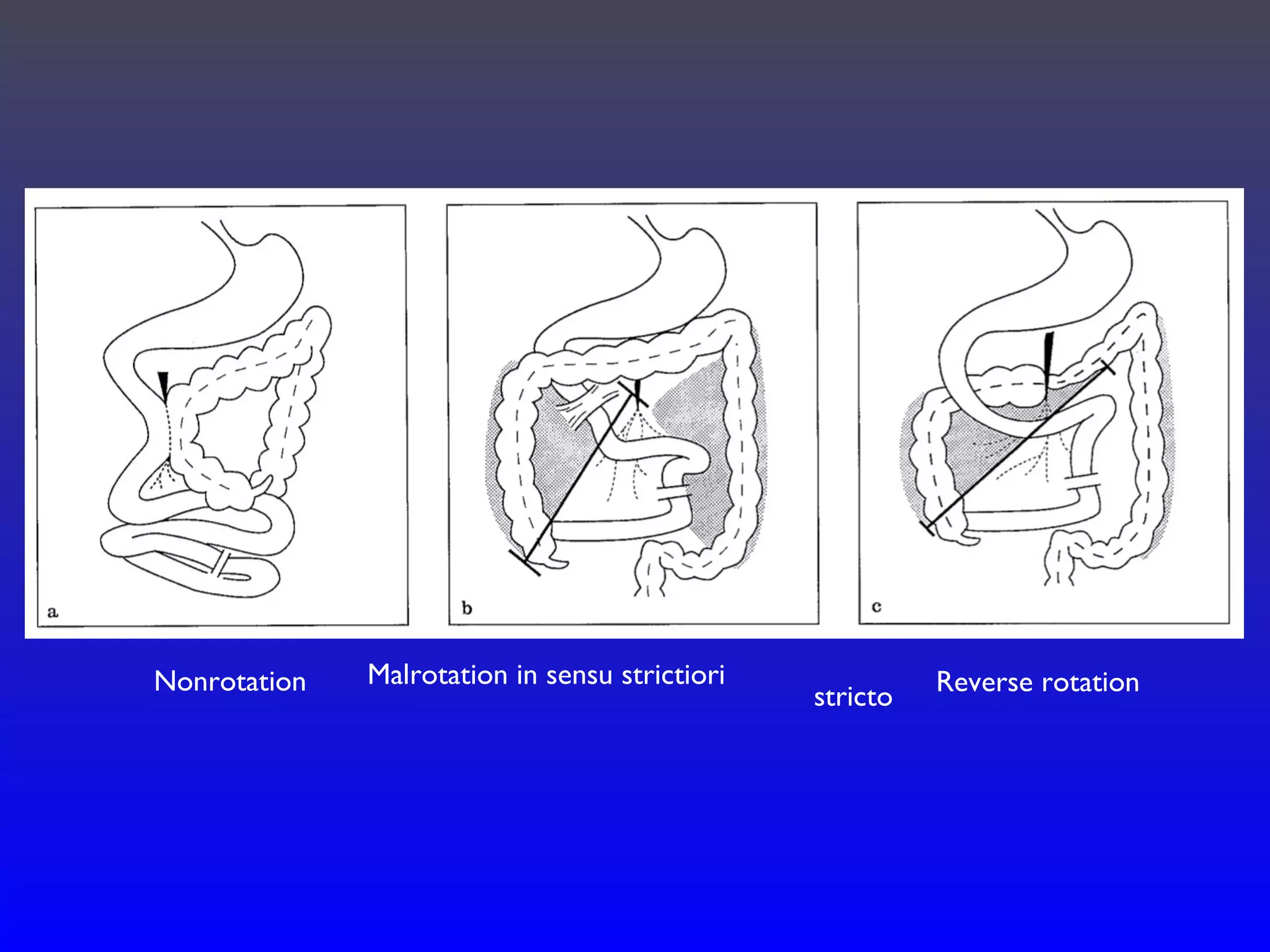 The Radiology of Malrotation | PPT