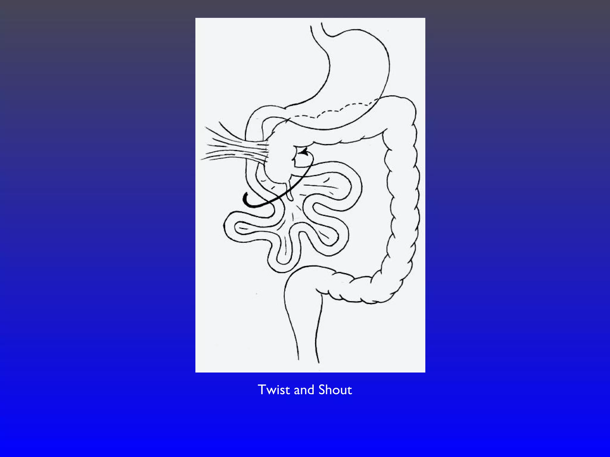 The Radiology of Malrotation | PPT