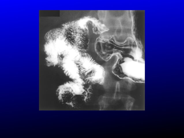 The Radiology of Malrotation | PPT