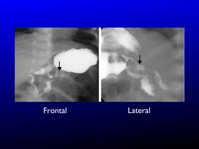 The Radiology of Malrotation | PPT