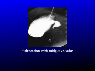 The Radiology of Malrotation | PPT