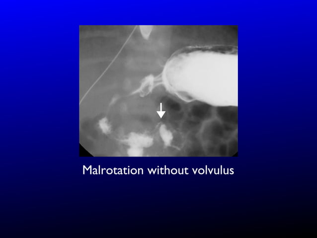 The Radiology of Malrotation | PPT