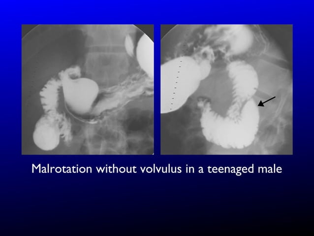 The Radiology of Malrotation | PPT