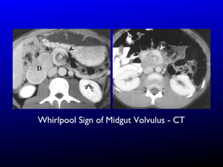 The Radiology of Malrotation | PPT