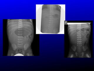 Malrotation With Volvulus Radiology