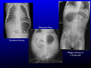 Midgut Volvulus X Ray