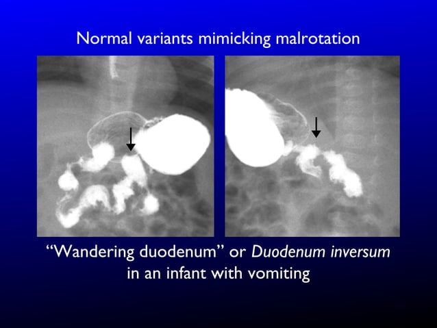 The Radiology of Malrotation