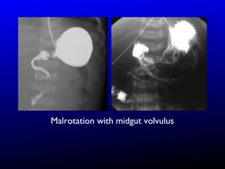 The Radiology of Malrotation | PPT