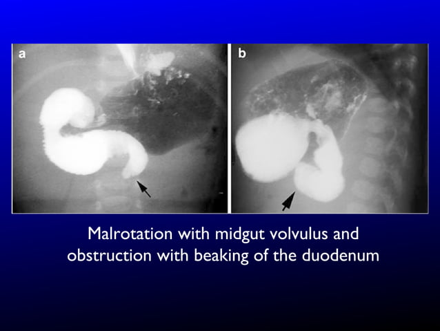 The Radiology of Malrotation