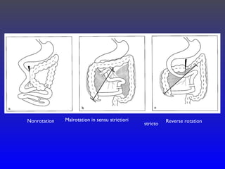 Malrotation