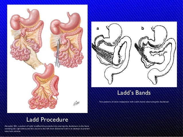 The Radiology of Malrotation