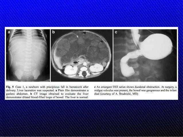 The Radiology of Malrotation
