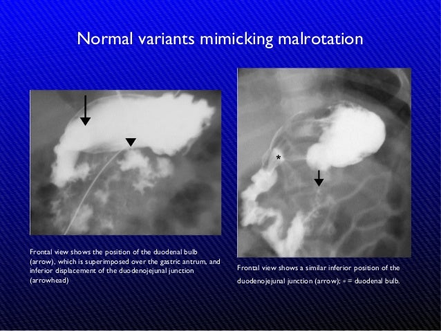 The Radiology of Malrotation