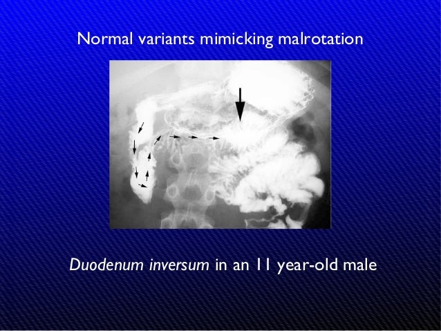 The Radiology of Malrotation