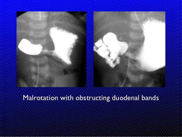 The Radiology of Malrotation