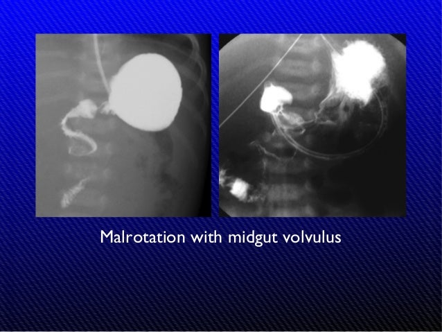The Radiology of Malrotation