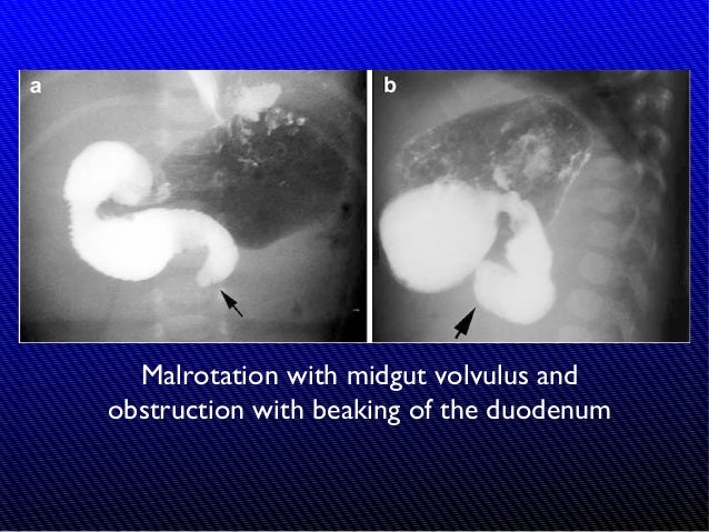 The Radiology of Malrotation