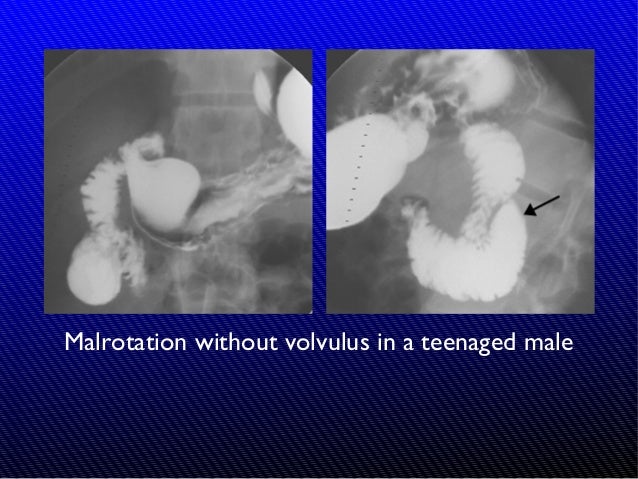 The Radiology of Malrotation