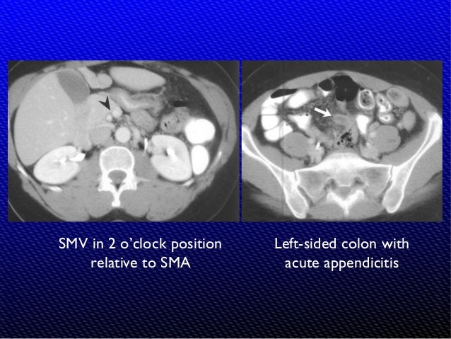 The Radiology of Malrotation