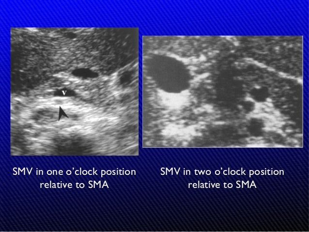 The Radiology of Malrotation