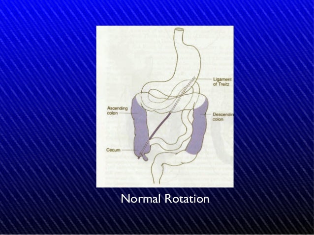 The Radiology of Malrotation