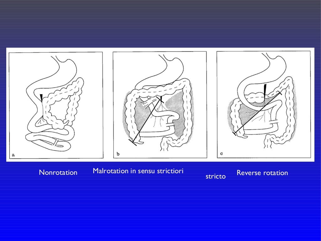 The Radiology of Malrotation