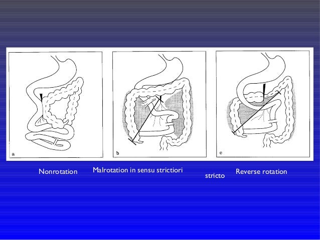 The Radiology of Malrotation