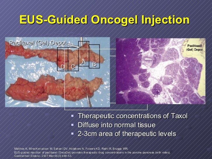 Therapeutic Eus 2008