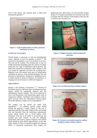 Therapeutic approach to epidermoid cyst | PDF