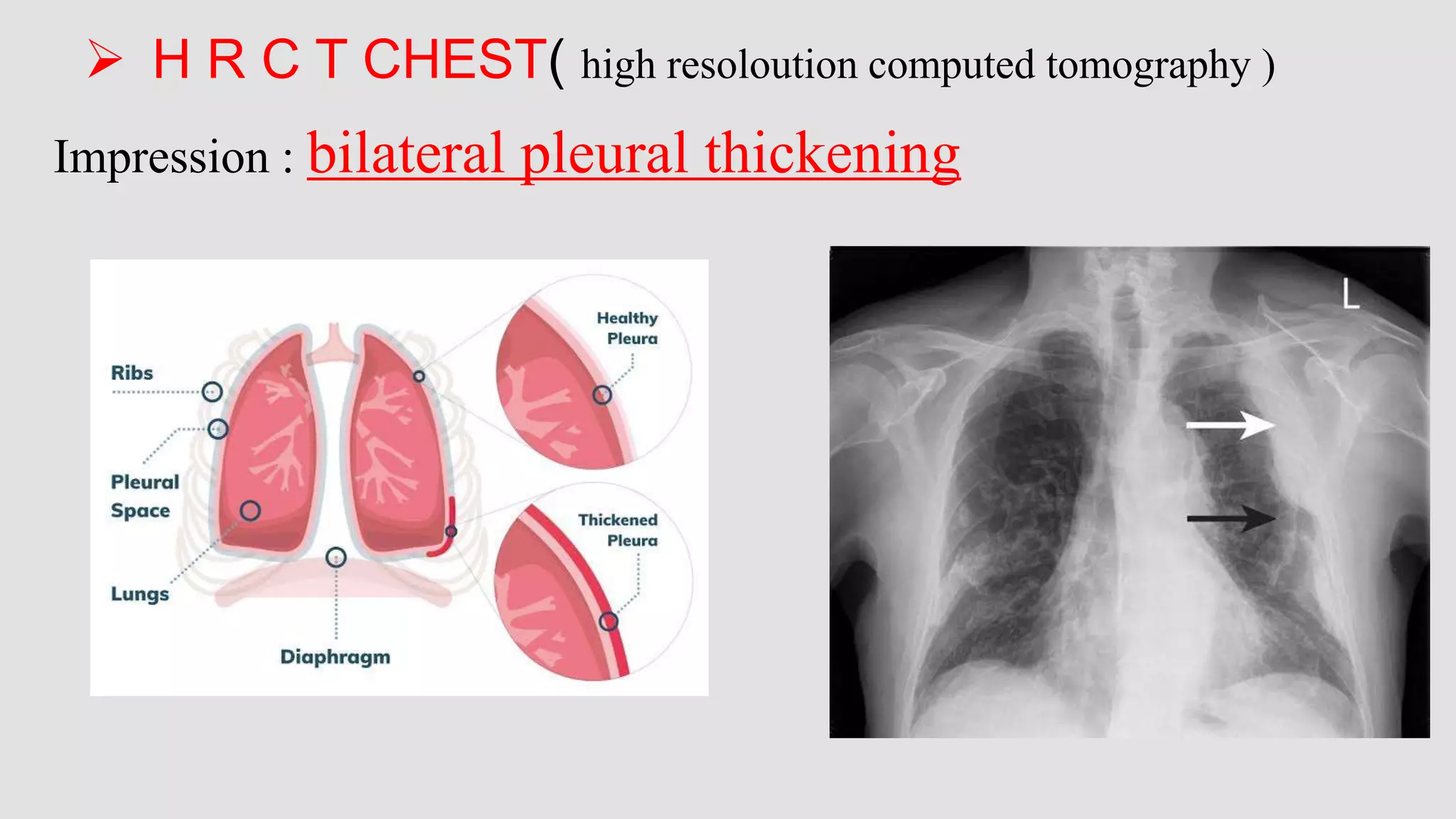 Acute exacerbation of asthma | PPTX