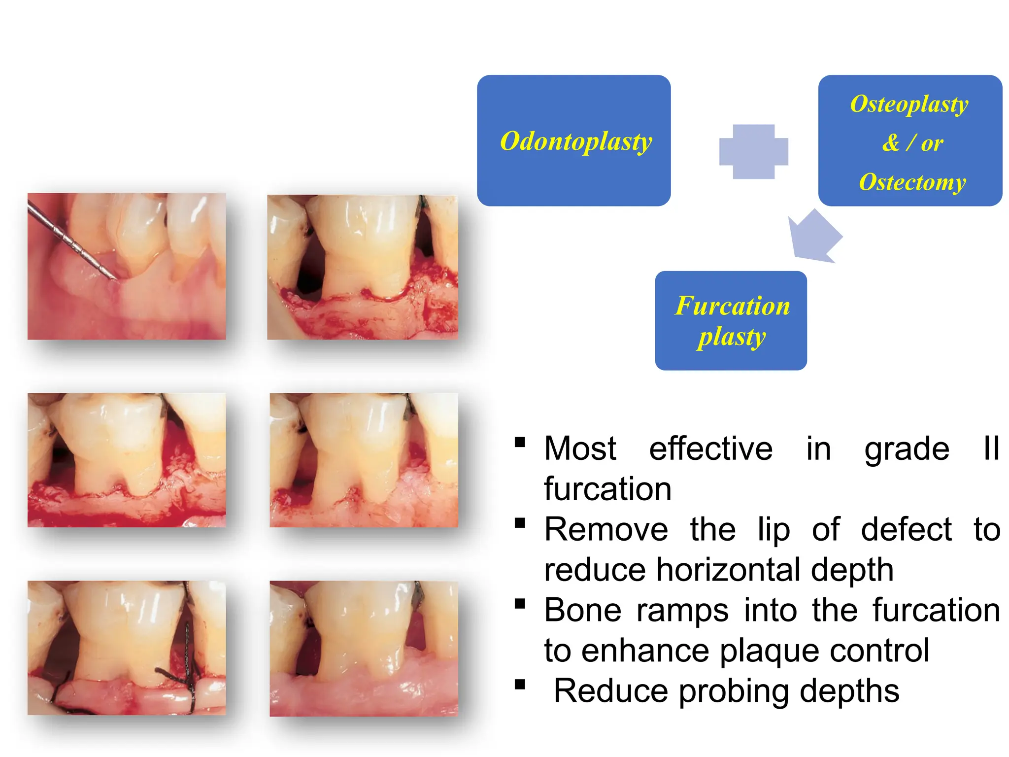 PPT - TREATMENT IN FURCATION INVOLVEMENT.pptx