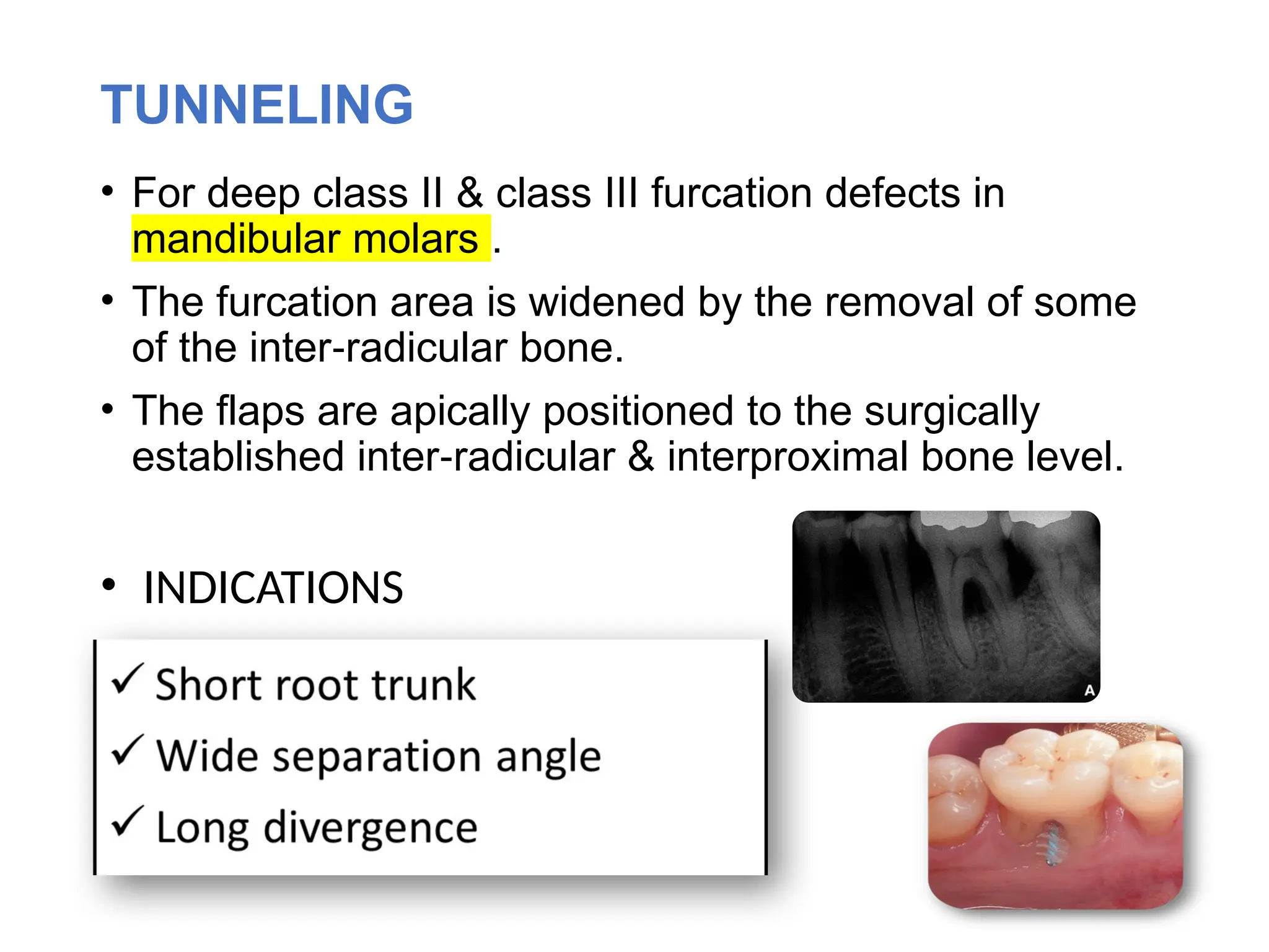 PPT - TREATMENT IN FURCATION INVOLVEMENT.pptx