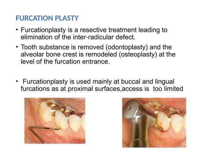 PPT - TREATMENT IN FURCATION INVOLVEMENT.pptx