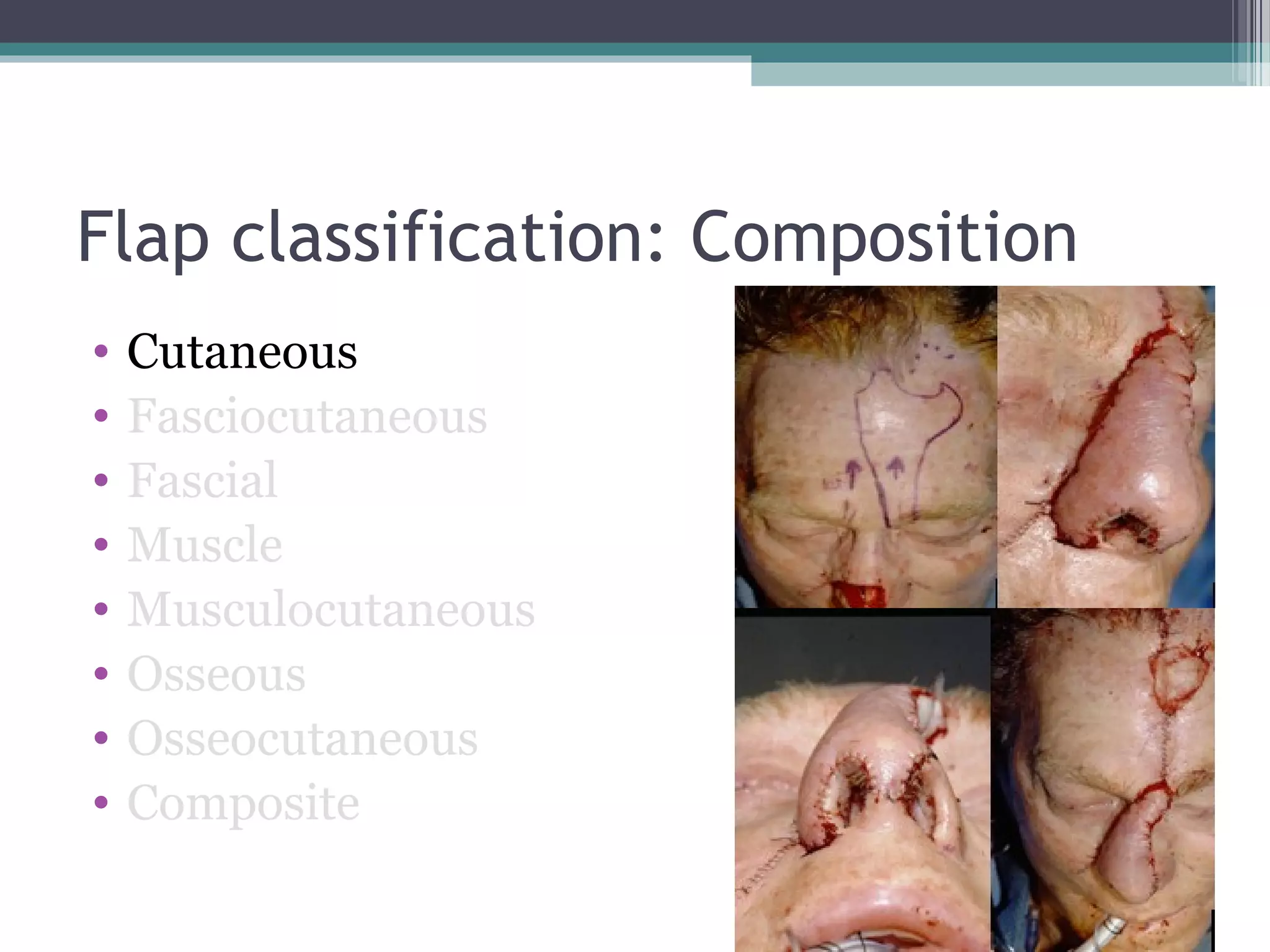 The Reconstructive Ladder - Mussa Mensa | PPT