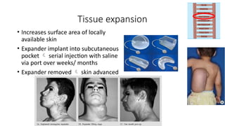 THE RECONSTRUCTIVE LADDER BY DR BINOD CHAUDHARY | PPTX