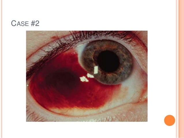 The red and painful eye