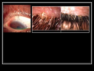 The red eye | PPT | Eye and Vision Conditions | Diseases and Conditions