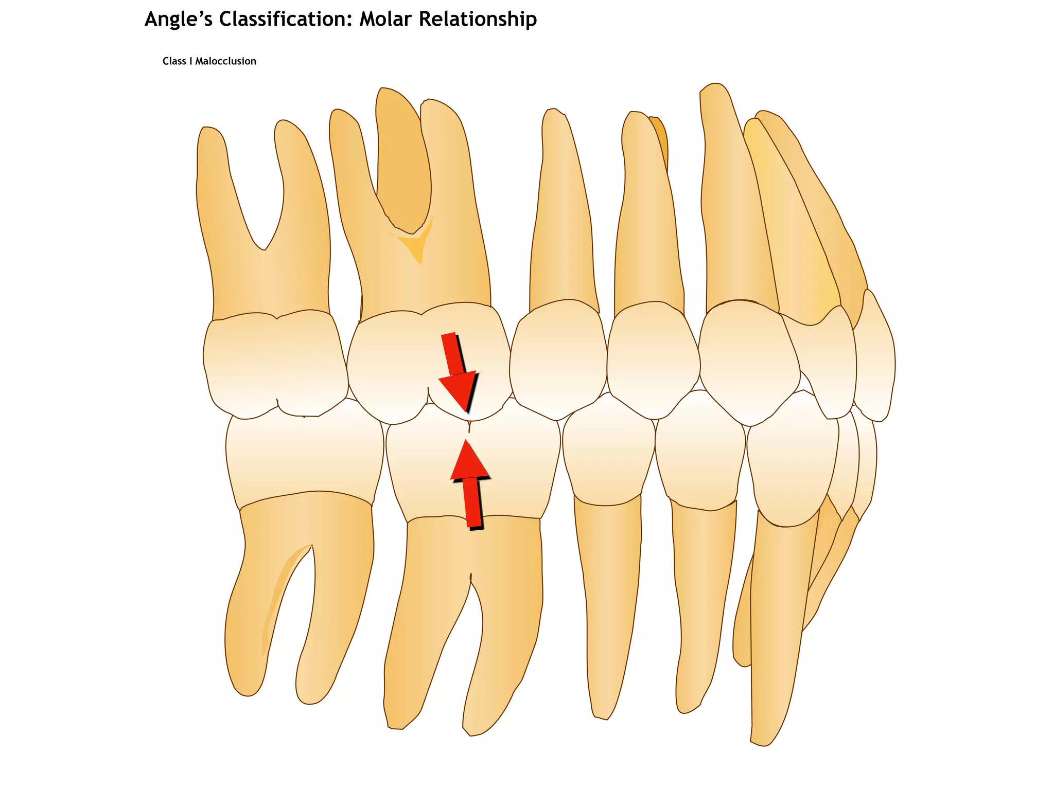 The relation between skeletal pattern and malocclusion (Incisor and ...