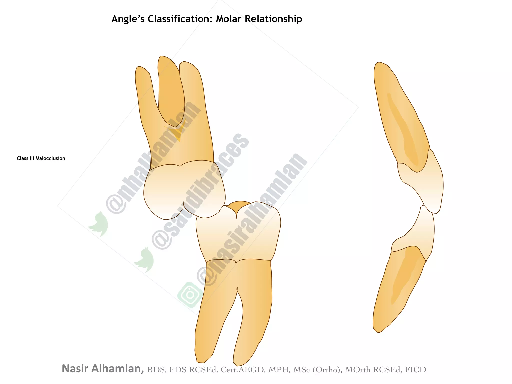 The relation between skeletal pattern and malocclusion (Incisor and ...