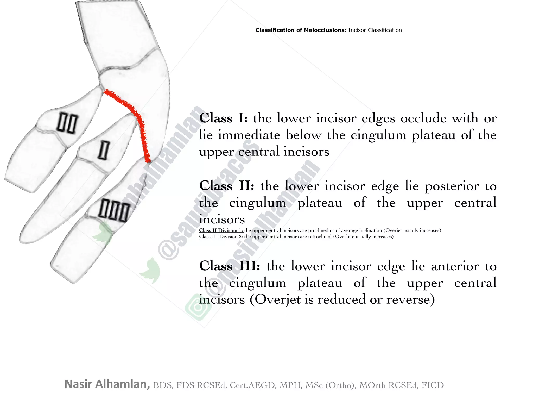 The relation between skeletal pattern and malocclusion (Incisor and ...