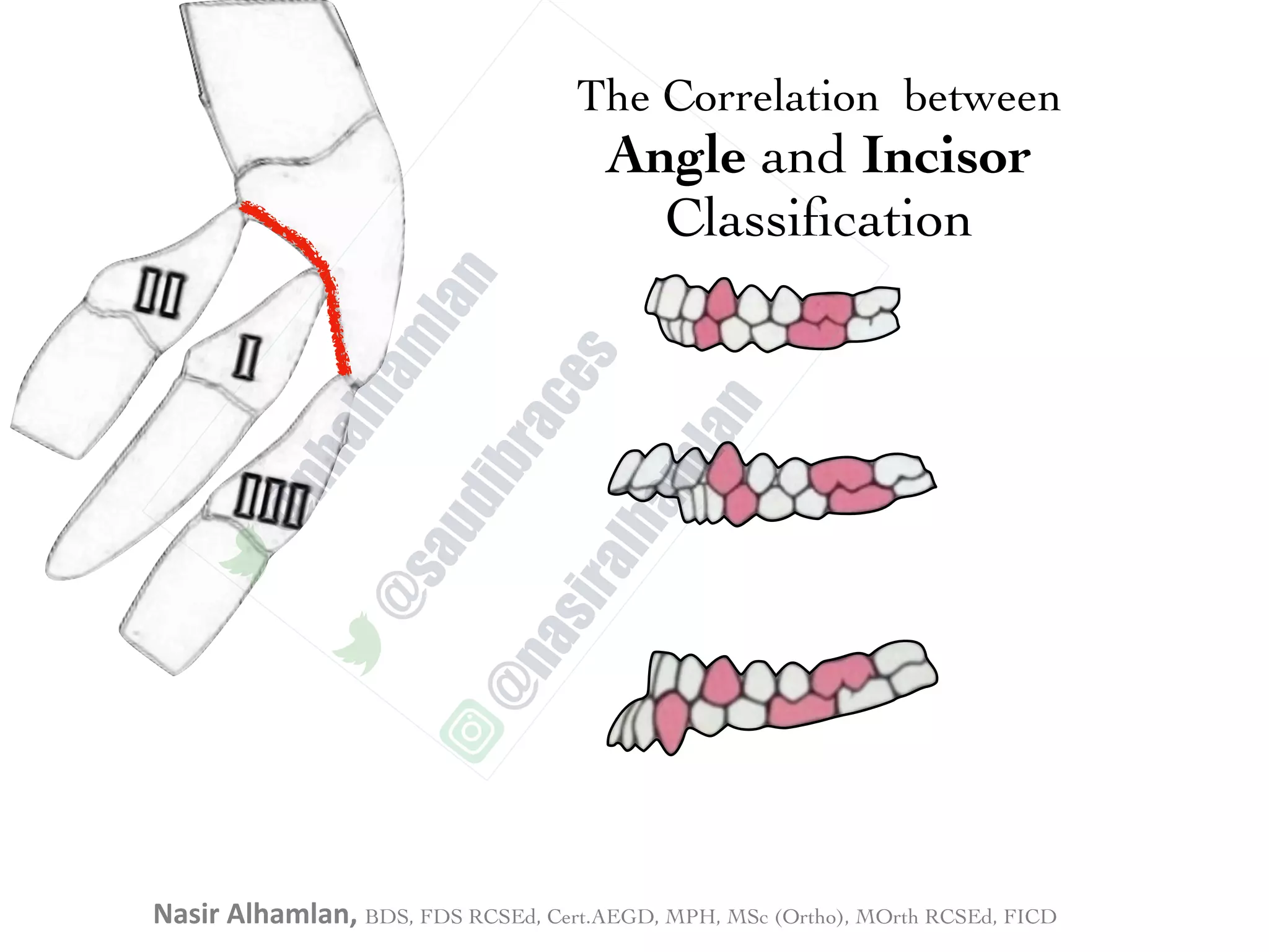 The relation between skeletal pattern and malocclusion (Incisor and ...